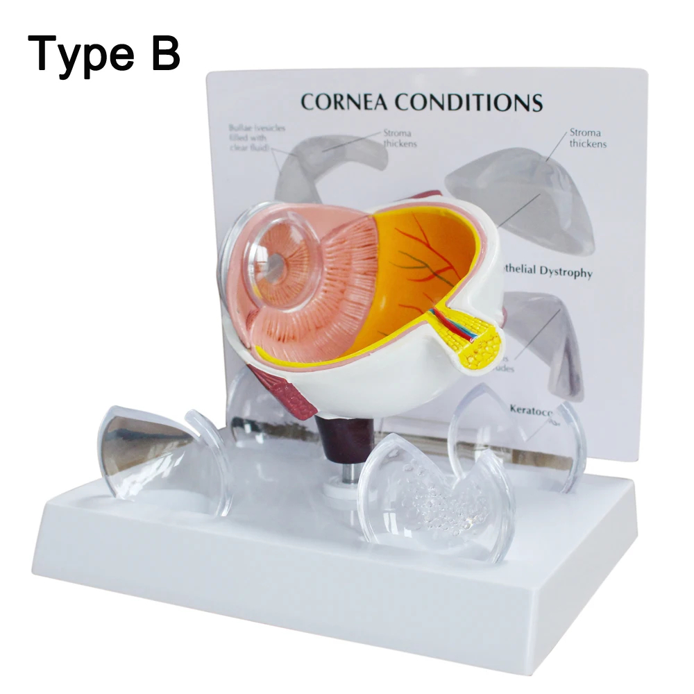 Cornea Eyeball Model Human Eye Demonstration Glaucoma Cataract Anatomy ...